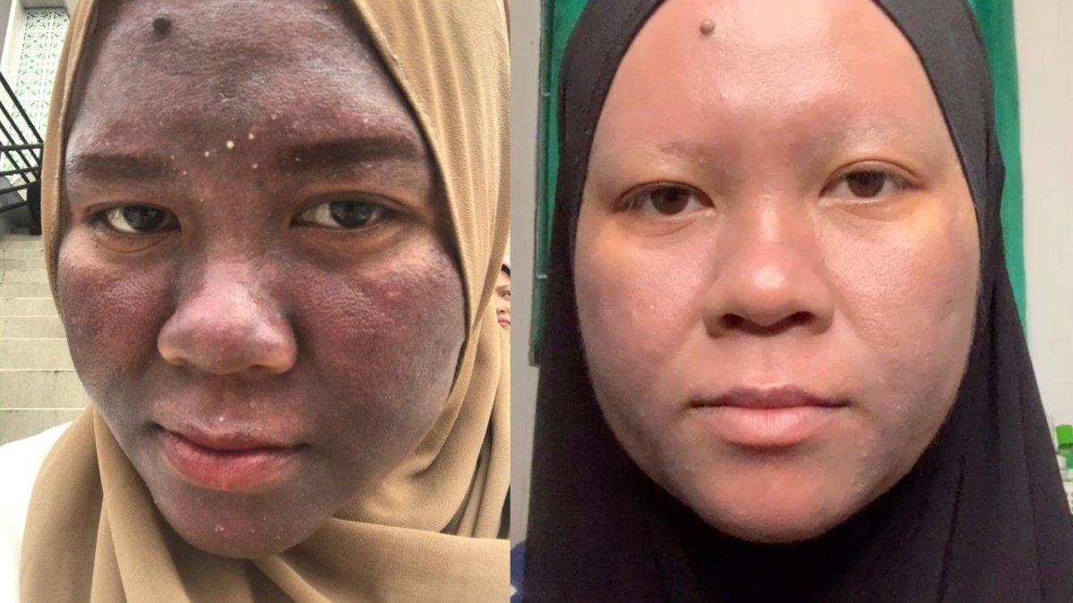 'Orang bilang wajah saya gosong seperti terkena azab' – Kosmetik ilegal ...
