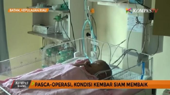 Kondisi Bayi Kembar Siam Asal Batam Membaik - TribunNews.com