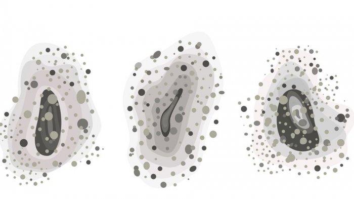 Kenali Infeksi Jamur Hitam yang Menyerang Seseorang Pasca Covid-19 ...