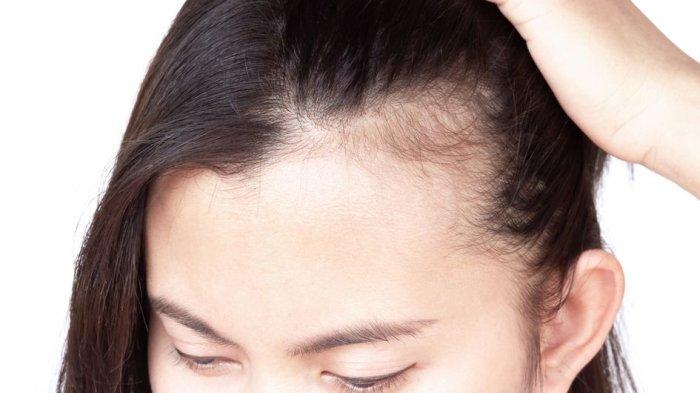 Jika Tak Ingin Garis Rambut Mundur, Kata Ahli Jangan Lakukan Hal Ini ...