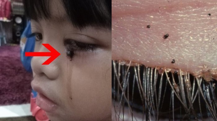 Anak Kesayangan Hobi Main Kucing, Ibu Ini Tak Menyangka Kutu Babi ...