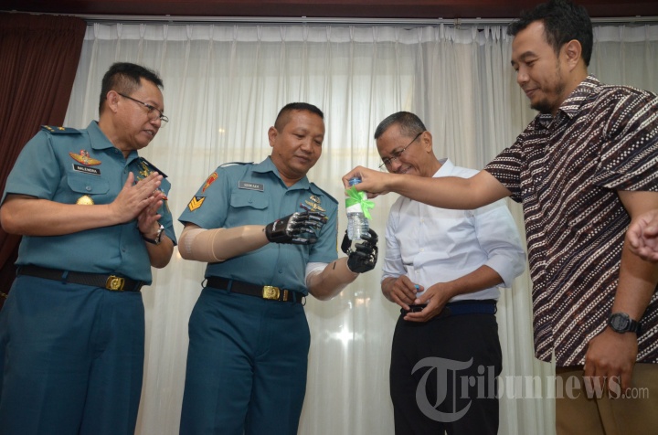 Tangan Bionic Produksi Undip dan RSAL Dr Ramelan, Foto 1 #1728701 ...