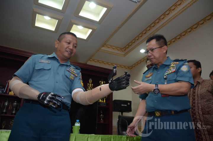 Tangan Bionic Produksi Undip dan RSAL Dr Ramelan, Foto 6 #1728706 ...