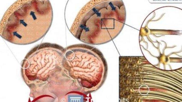 Diffuse Axonal Injury - TribunnewsWiki.com