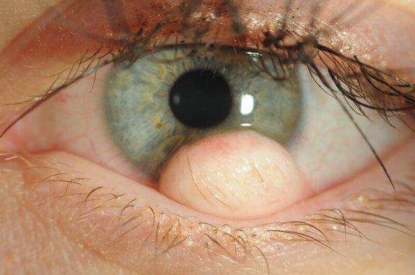Limbal Dermoid - TribunnewsWiki.com