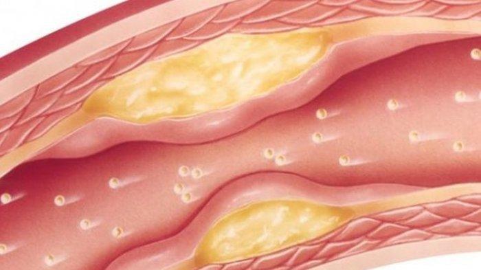 3 Gejala Trigliserida Tinggi yang Perlu Diwaspadai, Hindari Makanan ...