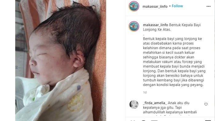 Viral Kepala Bayi Lonjong Akibat Vakum, Dokter Beri Tips Agar Kembali ...