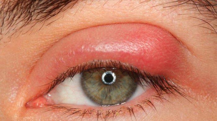 Blefaritis - TribunnewsWiki.com