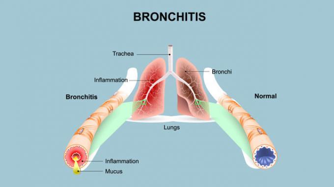 Bronkitis - TribunnewsWiki.com
