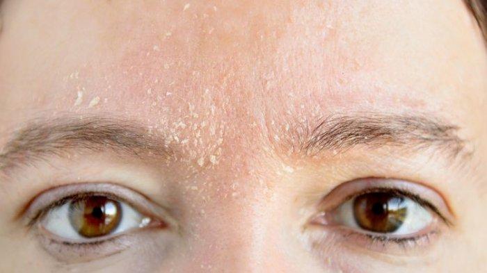 Dermatitis Seboroik - TribunnewsWiki.com