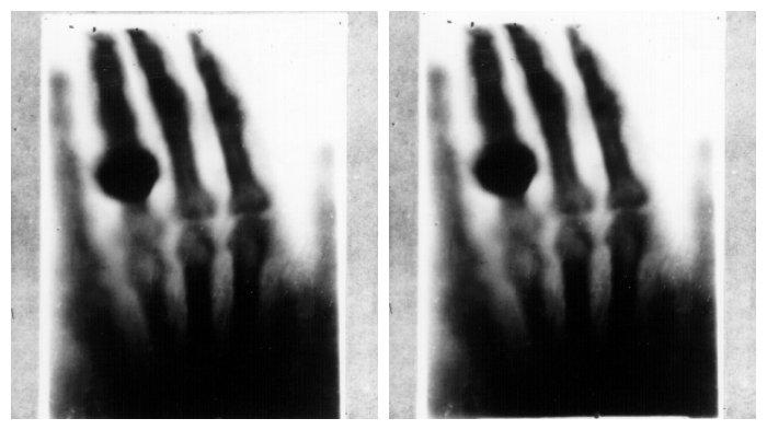 Hari Ini dalam Sejarah 8 November: Wilhelm Conrad Rontgen Menemukan ...