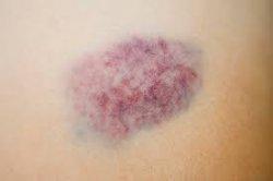 Hematoma - TribunnewsWiki.com