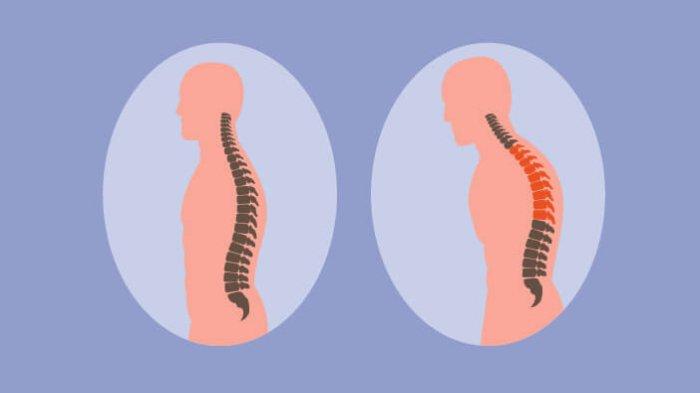 Kifosis - TribunnewsWiki.com