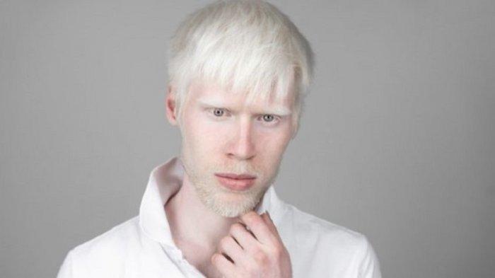 Albinisme - TribunnewsWiki.com