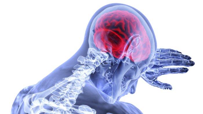 Hemiplegia - TribunnewsWiki.com