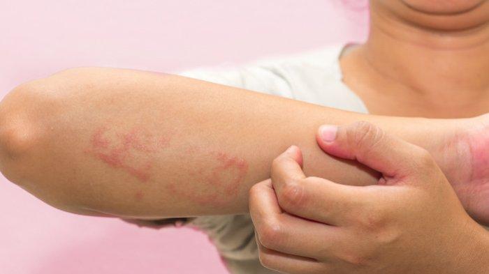 Penyakit Dermatitis Kontak - TribunnewsWiki.com
