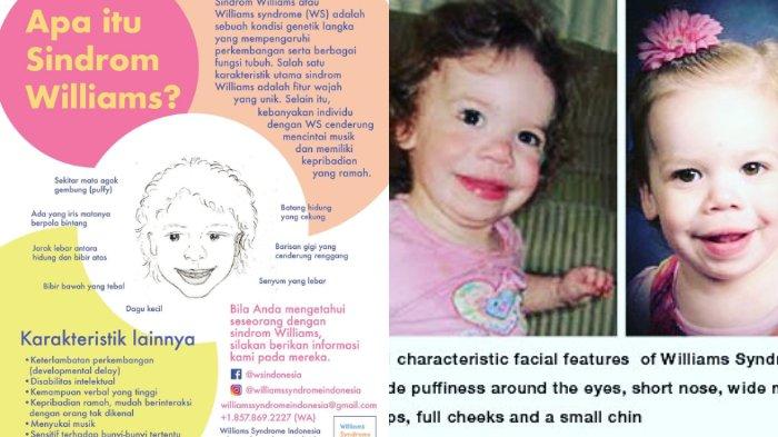 Sindrom Williams - TribunnewsWiki.com