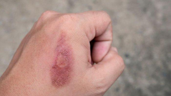 Bagaimana Cara Mengatasi Luka Bakar yang Benar? - Wartakotalive.com