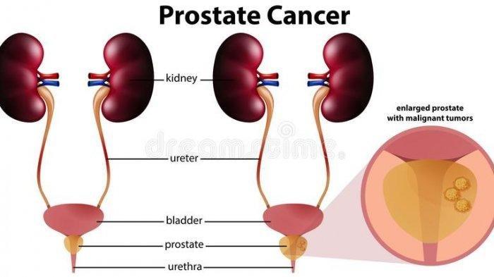 Pengobatan Kanker Prostat, Ada Terapi Lutetium PSMA yang Efektif dan ...