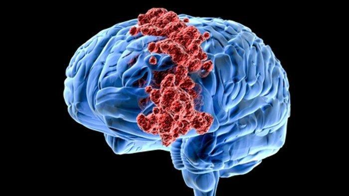 Tumor Padat pada Anak, Kenali Berbagai Gejala yang Tidak Biasa dan Cara ...