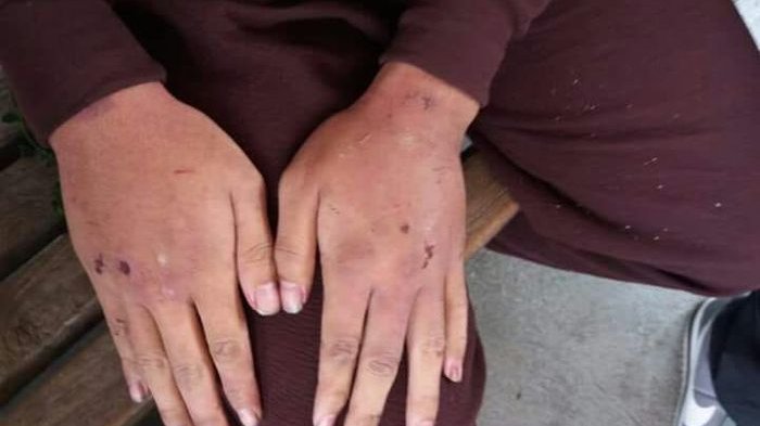 Sebelum Dibawa Ke Panti Sosial, Wajah Ali Sudah Lebam dan Badan Ada ...