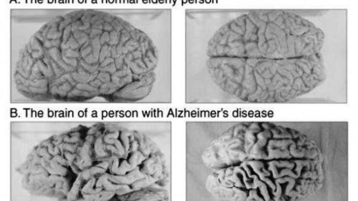 Perbedaan Mencolok Orang Normal, Alzeimer, dan Kecanduan Alkohol ...