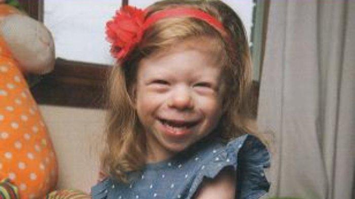 Mengenal Sindrom Williams atau Williams Syndrome, Pengidap Memiliki ...