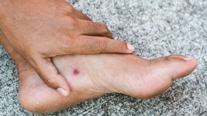 Penanganan Pertama dan Perawatan Luka Terbuka, dari Pakai Perban hingga ...